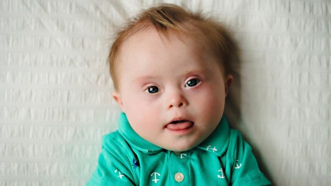 Bayi Down Syndrome Seperti Apa? Simak Jawabannya Disini